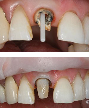 Infected Tooth Root Canal | Dentaris Dental Clinic
